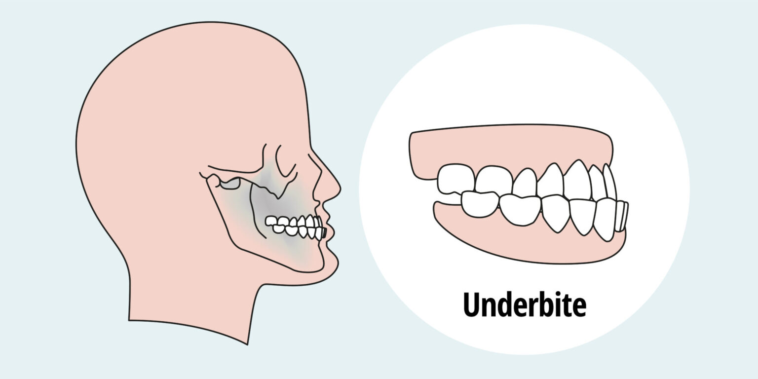 How to Fix an Underbite | Causes, Treatments, and Best Options