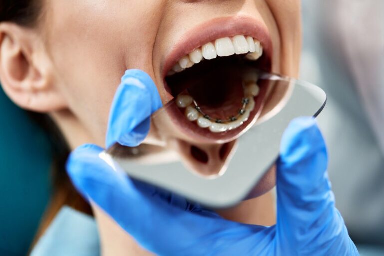 What Are Lingual Braces? | Ortho Co. Parramatta & Canterbury